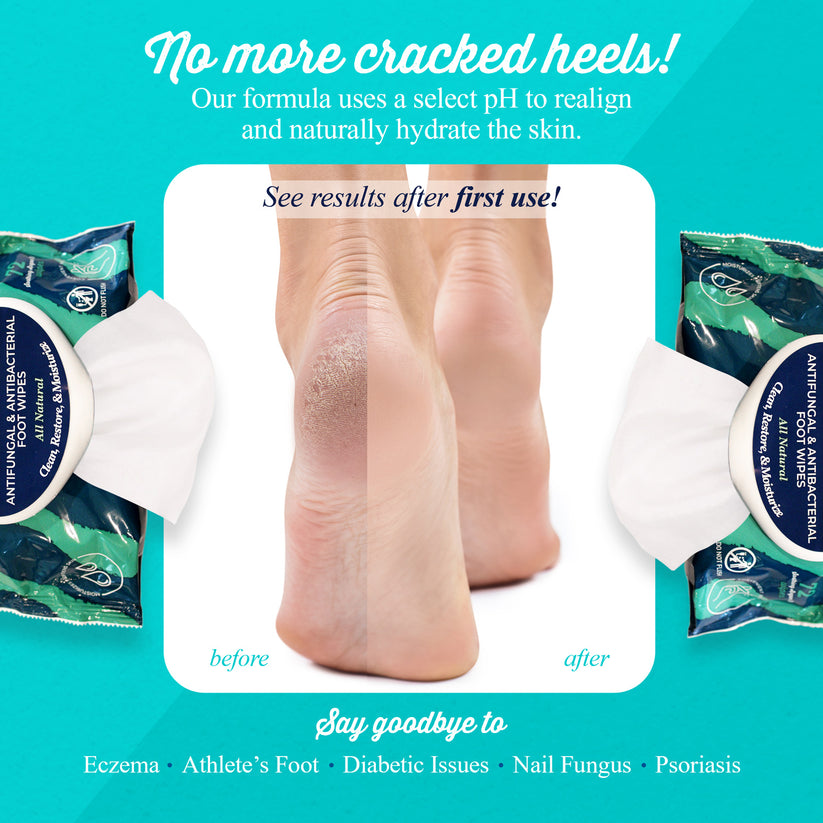 pHeet® Foot Wipes - All-Natural Antifungal & Antibacterial Formula – pH ...